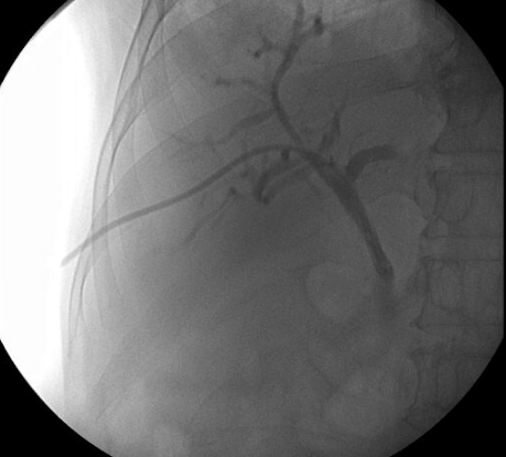PTGBD (percutaneous transhepatic gallbladder drainage) : 네이버 블로그