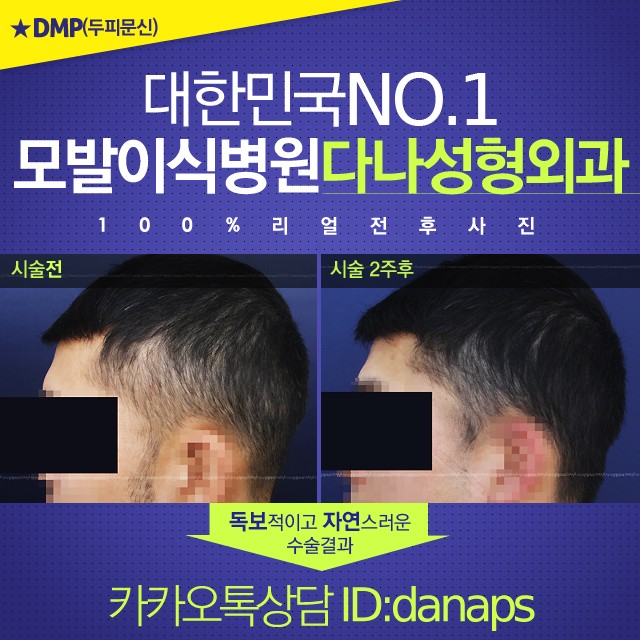 dmp ＆ 두피문신~~~ smp 야호야호~~ : 네이버 블로그