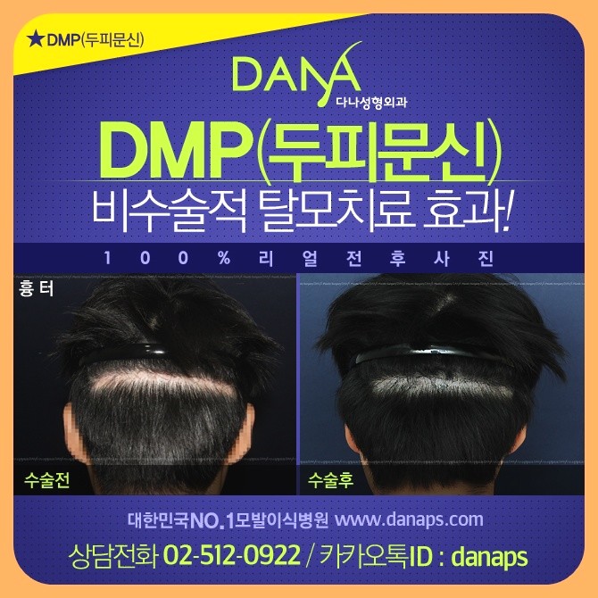 smp 시술 >> 두피문신 >> dmp 두피색소요법 : 네이버 블로그