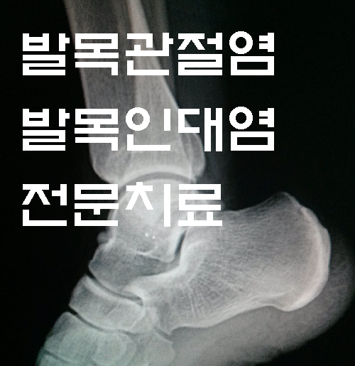 발목이 아픈 이유 발목이 붓는 이유 한 번 자세하게 알아보도록 하겠습니다 네이버 블로그