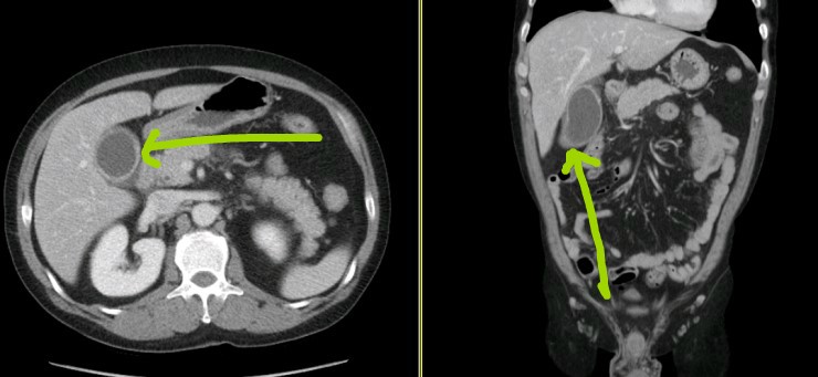 Acute and chronic cholecystitis - CT imaging : 네이버 블로그