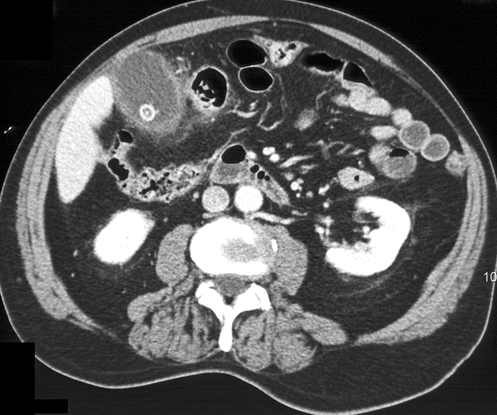 Acute and chronic cholecystitis - CT imaging : 네이버 블로그