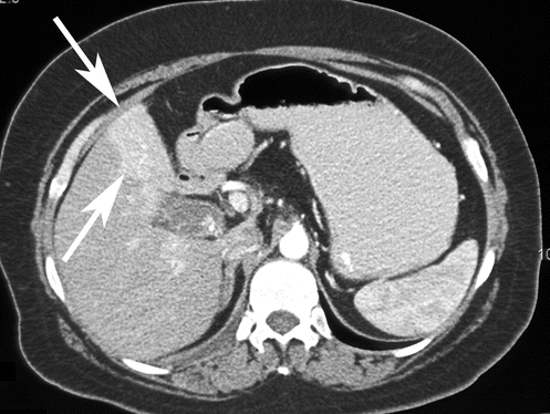 Acute and chronic cholecystitis - CT imaging : 네이버 블로그