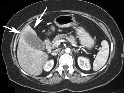 Acute and chronic cholecystitis - CT imaging : 네이버 블로그