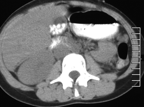 Acute and chronic cholecystitis - CT imaging : 네이버 블로그