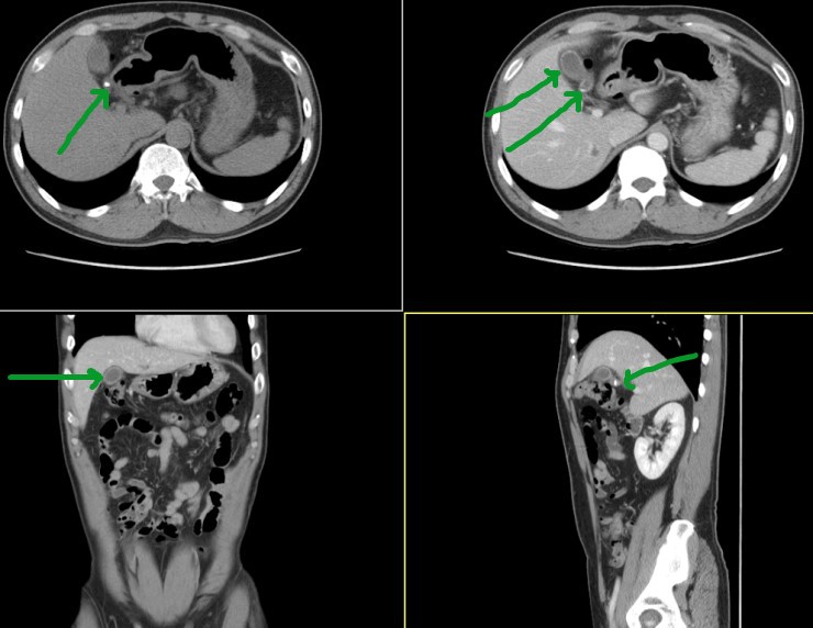 Acute and chronic cholecystitis - CT imaging : 네이버 블로그