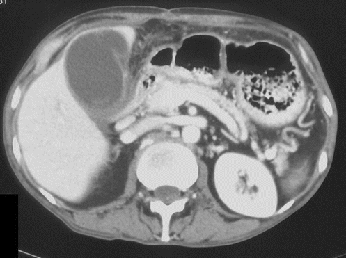 Acute and chronic cholecystitis - CT imaging : 네이버 블로그