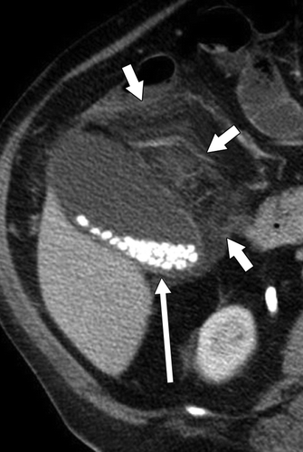 Acute and chronic cholecystitis - CT imaging : 네이버 블로그