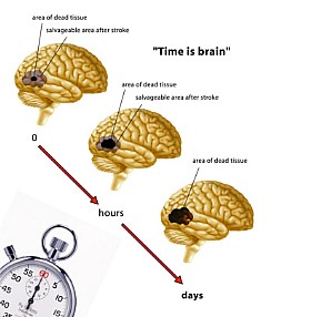[문성병원 재활 상식] 뇌졸중 회복의 중요한 요소 (1) Time is Brain : 네이버 블로그