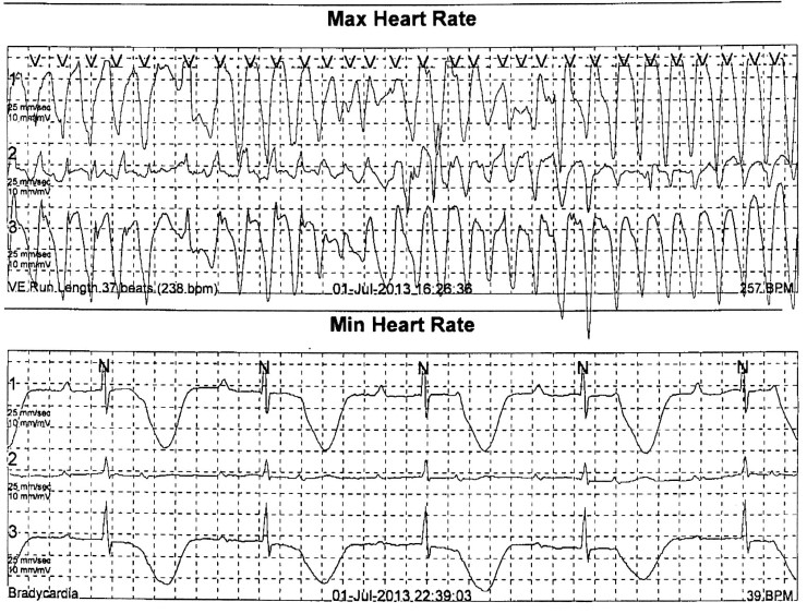 Bradycardia and TdP (서맥과 염전성 심실빈맥) : 네이버 블로그