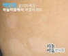 ㅃㄸ 백반증 초기증상 ㅜ 소아백반증 네이버 블로그