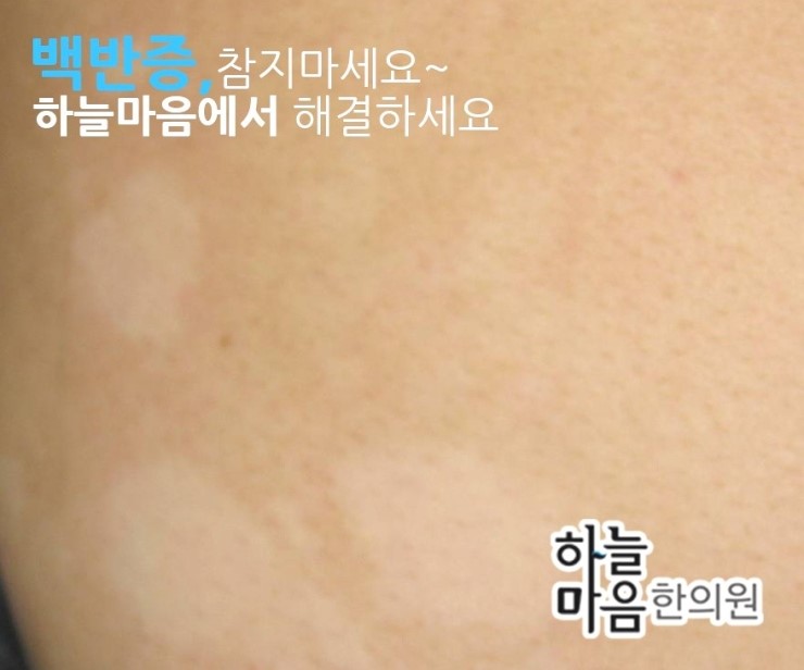 ㅃㄸ 백반증 초기증상 ㅜ 소아백반증 네이버 블로그