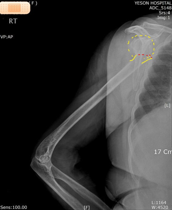 상완골 경부 삼분 골절에서의 관혈적 정복술 및 내고정술 Orif Of Humerus Neck Fracture 네이버 블로그