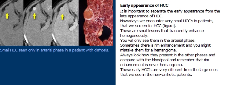 HCC, liver dynamic CT : 네이버 블로그