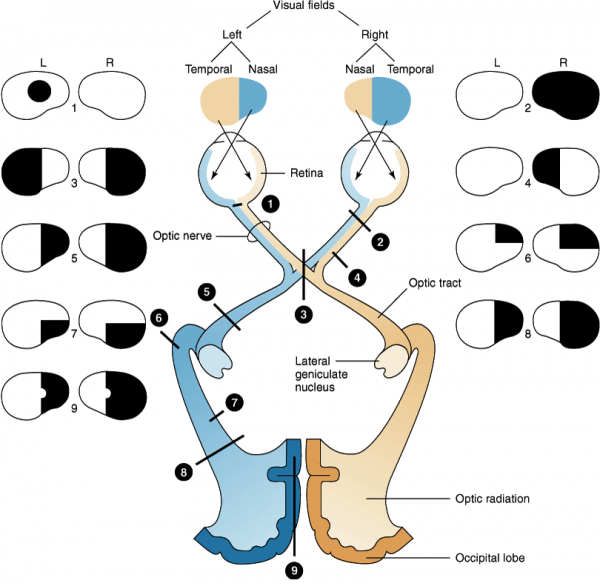 Hemianopsia vs Hemianopia : 네이버 블로그