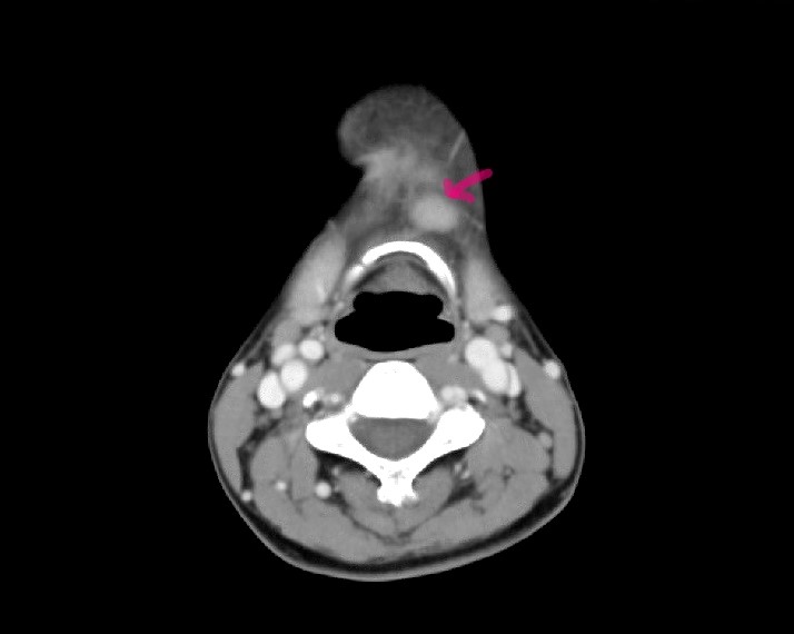 Submental lymphadenopathy : 네이버 블로그