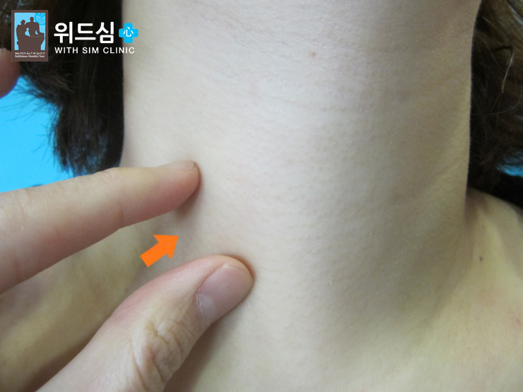 목 옆에 멍울 목 뒤에 멍울등 목질환 전문의 진찰이 중요한 이유 네이버 블로그