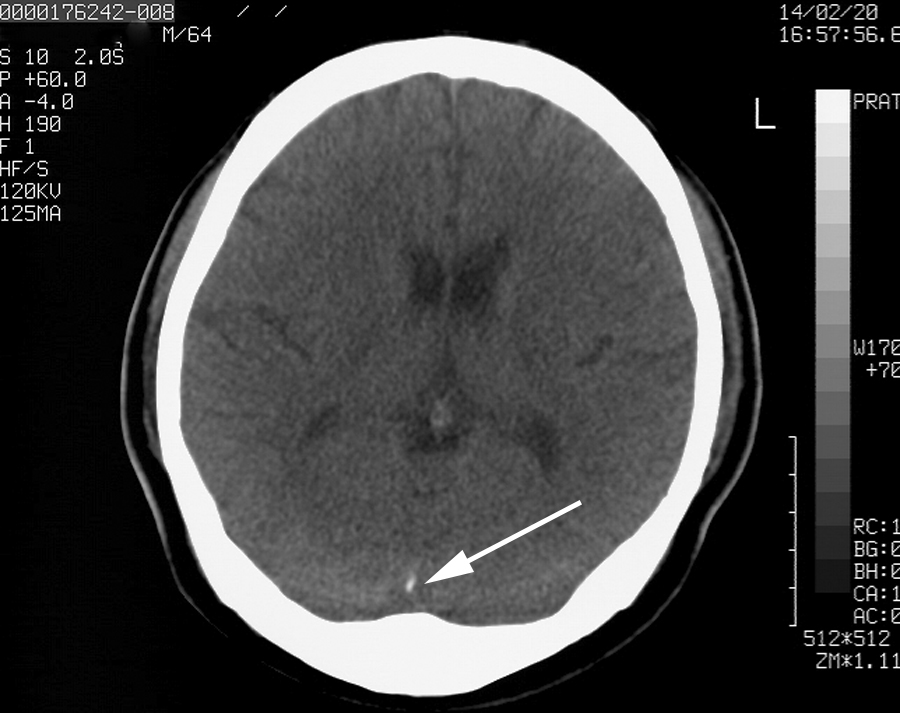 Normal intracranial calcifications(정상적인 두개내(뇌속) 석회화) : 네이버 블로그