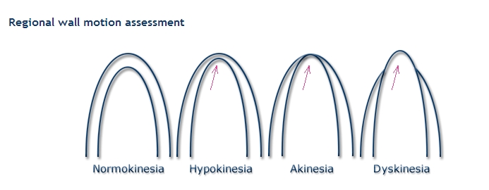 Regional wall motion abnormality : 네이버 블로그