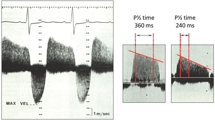 AR (Aortic regurgitation) (2) - Echocardiogram 평가 (1) : 네이버 블로그