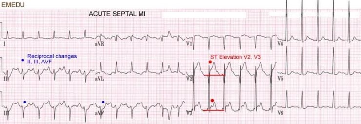 Septal STEMI ♣ : 네이버 블로그