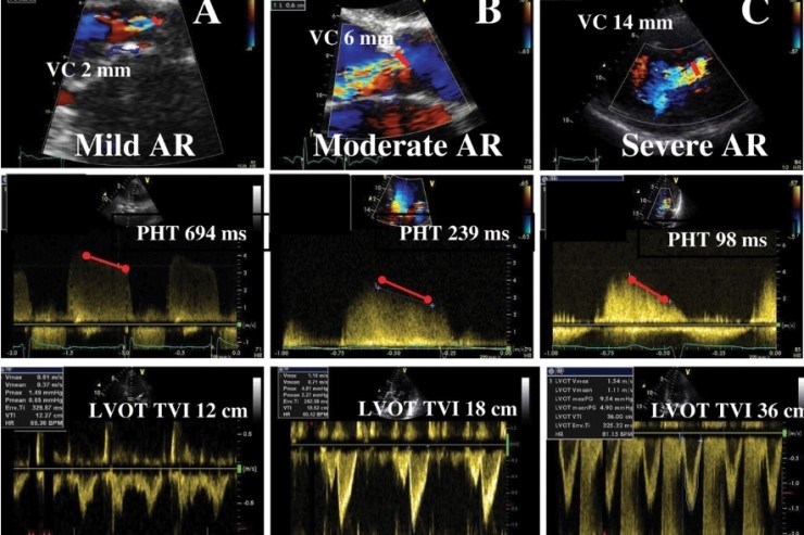 AR (Aortic regurgitation) (2) - Echocardiogram 평가 (1) : 네이버 블로그