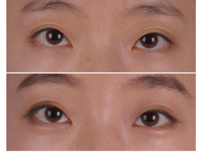 삼백안이 있다면 이마눈썹거상을 고려한다. (Endoscopic forehead brow lift should be ...