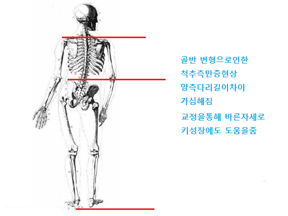 골반 변형측만증다리길이차이 골반교정척추교정병점동탄오산수원화성용인영통 네이버 블로그