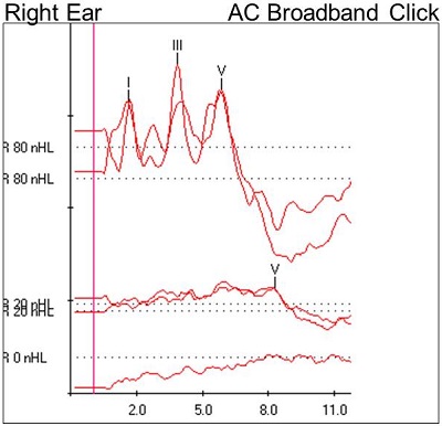 청성 뇌간 반응검사 (auditory brainstem response test,ABR) : 네이버 블로그