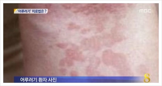피부 어루러기 건강정보 여름철 피부가 얼룩덜룩 변하는 어루러기 예방법 어우러기 치료 원인 및 증상 네이버 블로그