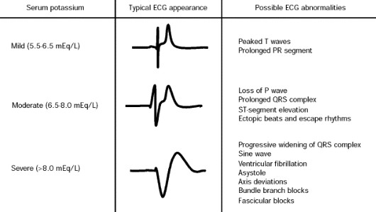 ST_T wave change,hypokalemia, ischemia, : 네이버 블로그