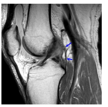 반장슬(Back Knee)의 정의와 원인, genu recurvatum, 뒤로 휜다리 : 네이버 블로그