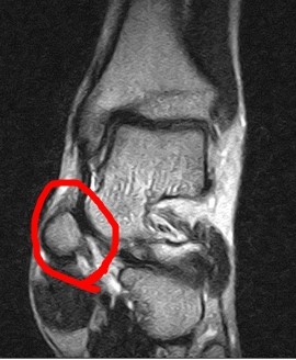 부주상골 (Accessory navicular syndrome = PreHallux) : 네이버 블로그