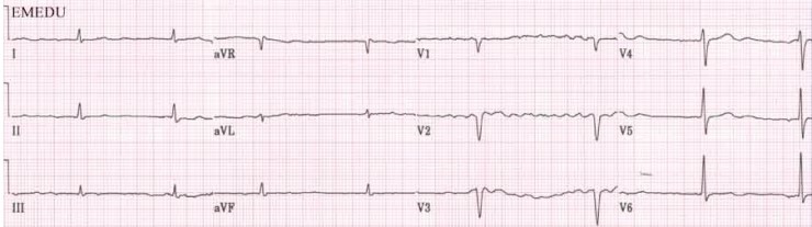 Atrial fibrillation(AF, Afib, A. fib)★ : 네이버 블로그
