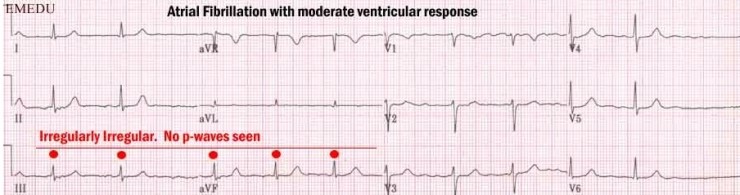 Atrial fibrillation(AF, Afib, A. fib)★ : 네이버 블로그
