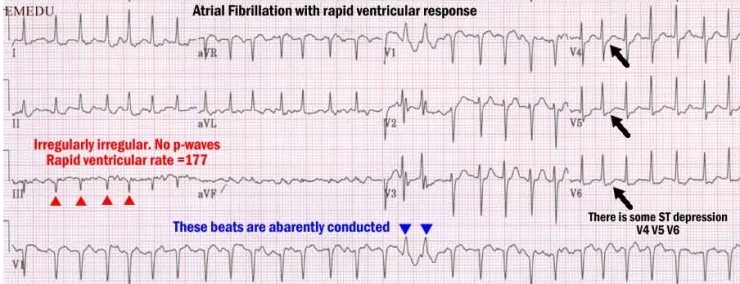 Atrial fibrillation(AF, Afib, A. fib)★ : 네이버 블로그