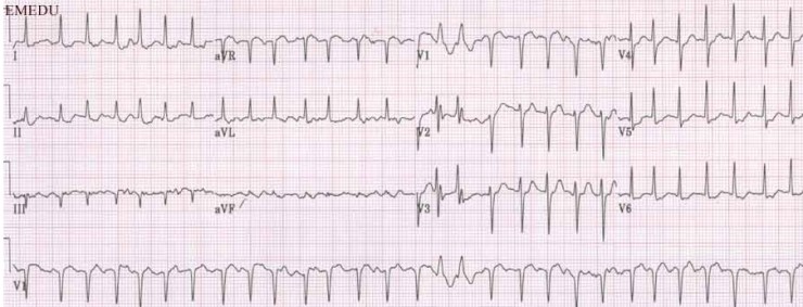 Atrial fibrillation(AF, Afib, A. fib)★ : 네이버 블로그
