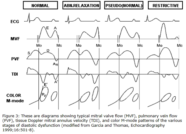 승모판 유입 전파 속도 (Mitral inflow propagation velocity, Vp) : 네이버 블로그