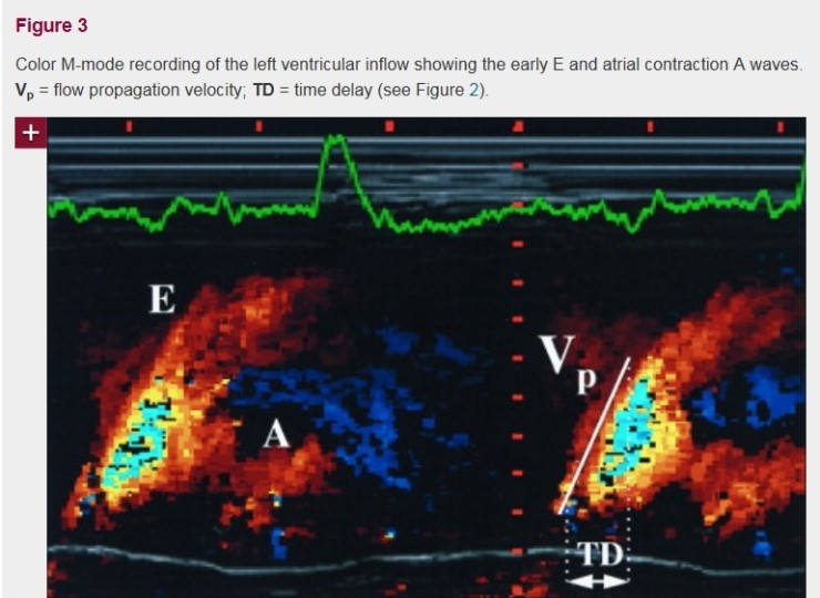 승모판 유입 전파 속도 (Mitral inflow propagation velocity, Vp) : 네이버 블로그