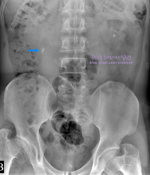 요로결석 체외충격파쇄석술후 통증(체외충격파쇄석술의효과가 떨어지는 경우) steinstrasse : 네이버 블로그