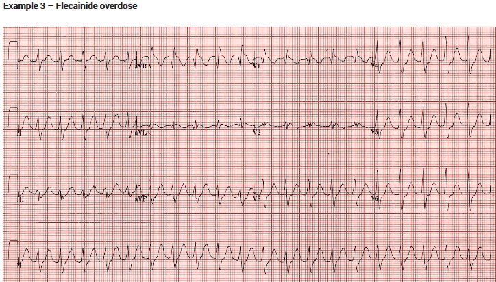 Tca Overdose Ecg 네이버 블로그