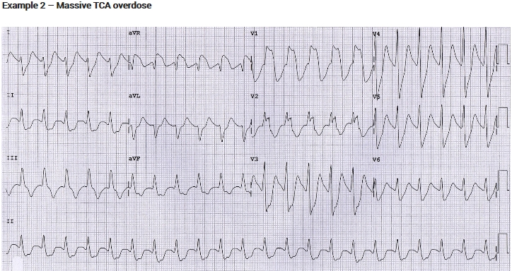 TCA overdose, ECG : 네이버 블로그