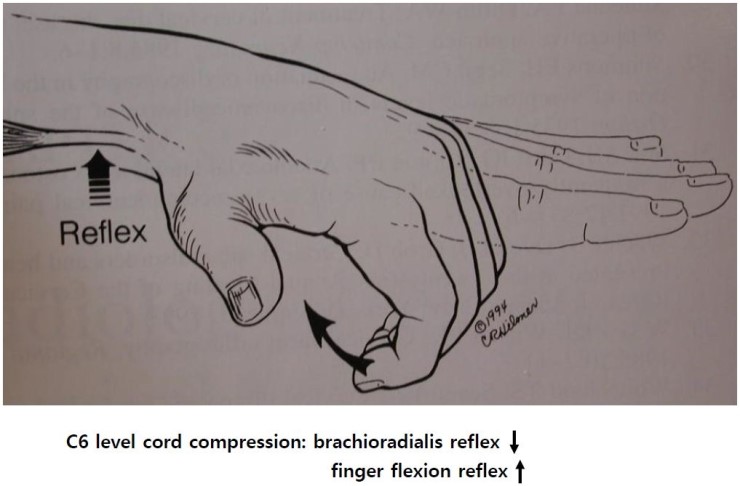 [의학] 척추 진찰법 정리 : 네이버 블로그