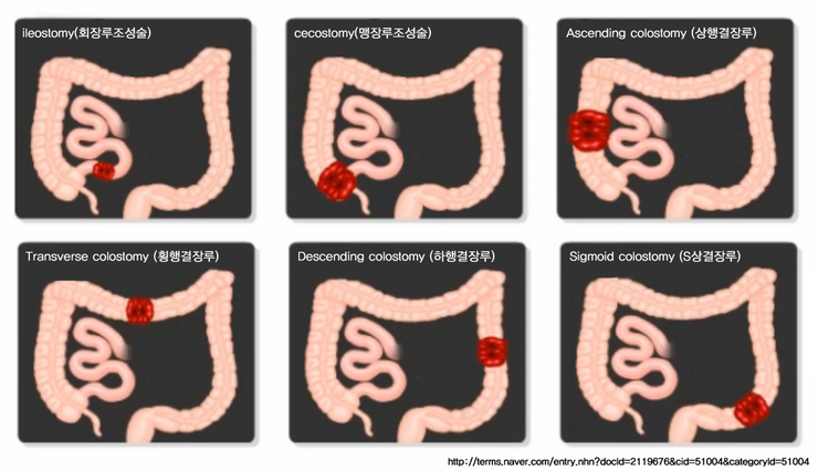 장루(Stoma) : colostomy, ileostomy, Loop stoma (환상 장루), End stoma (말단 장루 ...