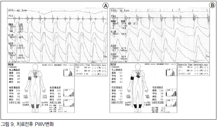 PWV (Pulse wave velocity) : 네이버 블로그