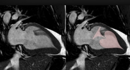비후성심근병증 (HCMP, hypertrophic cardiomyopathy)의 진단과 치료 : 네이버 블로그