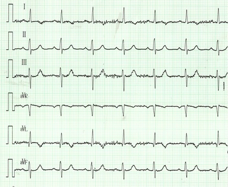 Poor R Wave Progression (PRWP) ECG : 네이버 블로그