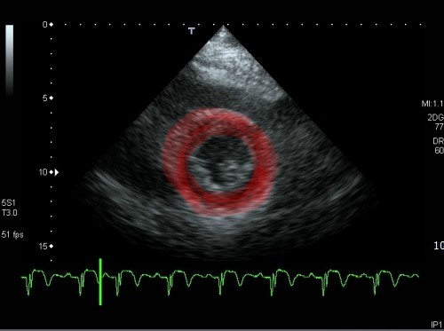 Poor R Wave Progression (PRWP) ECG : 네이버 블로그