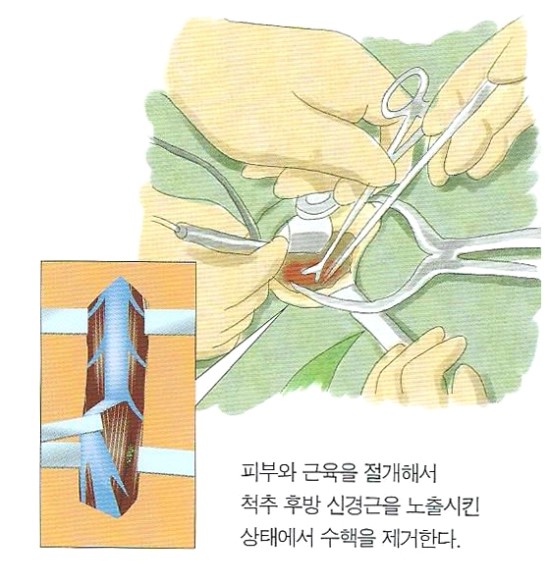 척추관절우신향병원 디스크수술법 개방적 수술법 척추뼈 융합술 인공 디스크 치환술 척추 연성 고정술 네이버 블로그