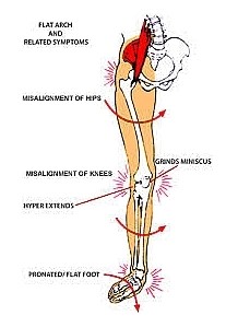 [얀다의 교차증후군] 엎침비틀림증후군 Janda's Pronation Distortion Syndrome (발바닥통증, 발목통증 ...